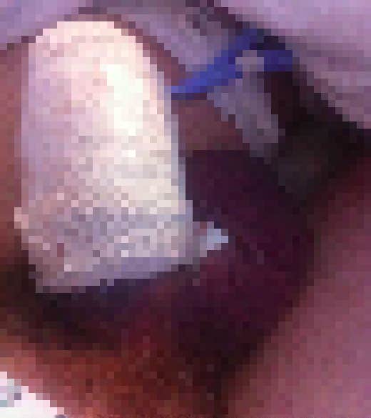 A Man Suffered A Broken Penis While Having Vigrorous Sex Yourtango